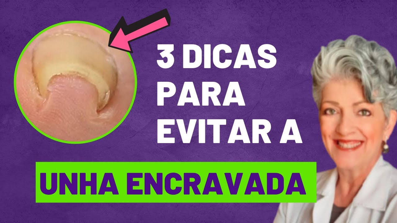 3 DICAS INFALÍVEIS para evitar a UNHA ENCRAVADA - YouTube