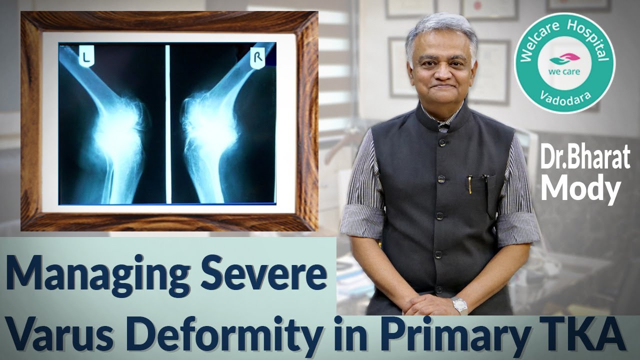 10) LECTURE - 10 Managing Severe Varus Deformity in Primary TKA - YouTube