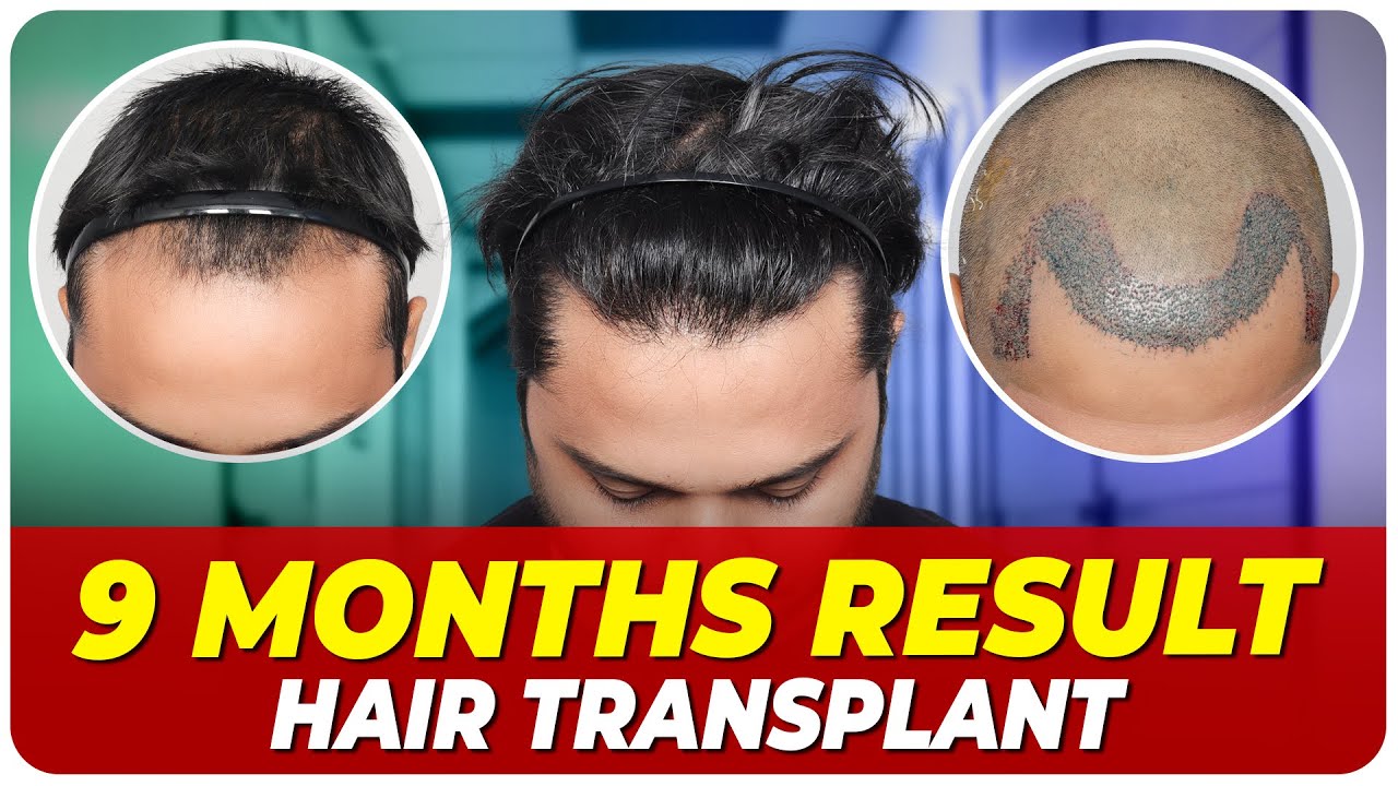 Hair Transplant Time Lapse Step By Step Hair Transplant Surgery Time