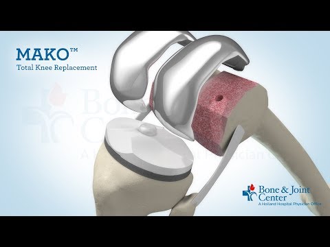 Full Knee Replacement | Mako Robotic Arm Assisted Surgery Technology