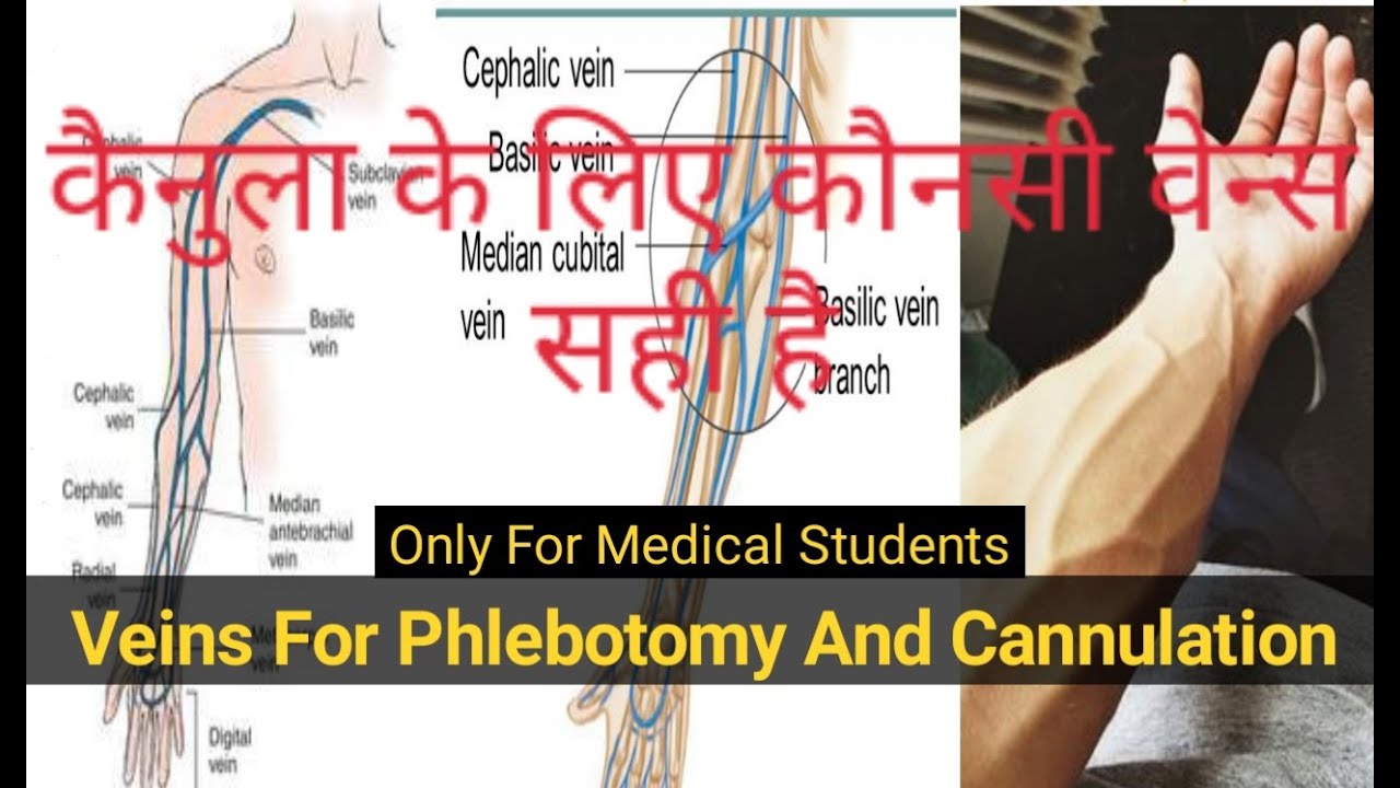 Cannula Site Findings Childrens And Adults / Veins For Cannulation ...
