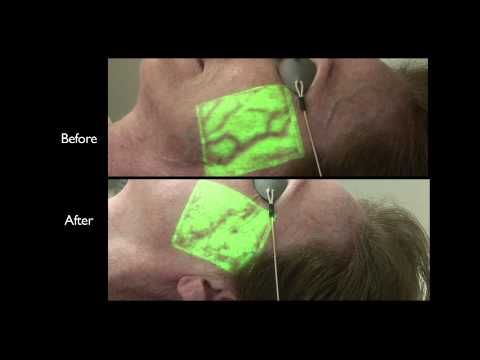 Augmented Reality on Dermatology: Transdermal Laser in Facial Vein ...