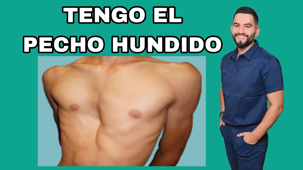TENGO EL PECHO HUNDIDO / PECTUS EXCAVATUN | DR. DAVID CAMPOS - YouTube