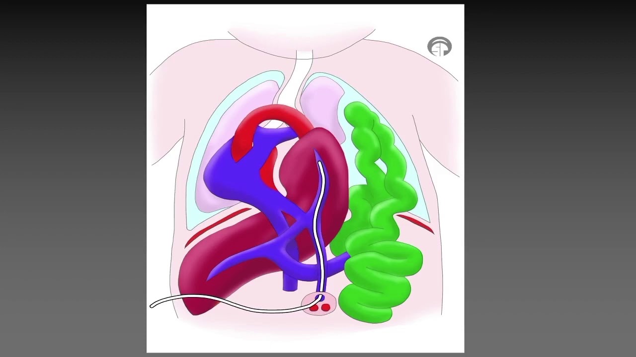Intravascular catheters in pediatric patients - YouTube