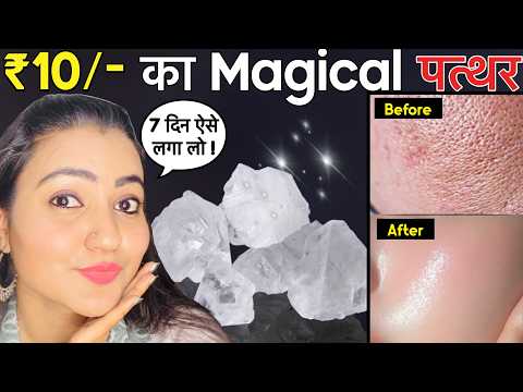 त्वचा की मुश्किल से मुश्किल समस्या का 100% इलाज़ सिर्फ 10 रूपए की चीज़ से | Alum (Fitkari) for Skin
