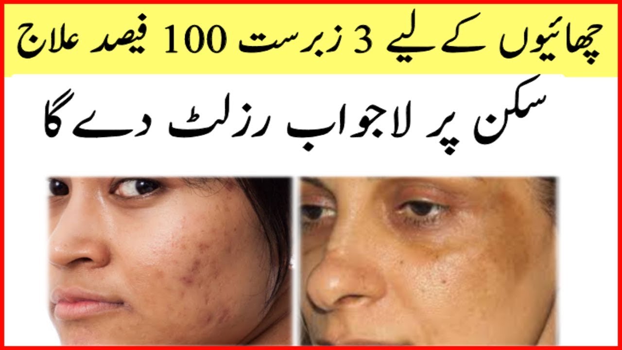 3 Types Of Face Mask For Freckles - YouTube