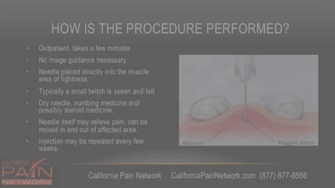 Trigger Point Injections explained by a Los Angeles pain management ...