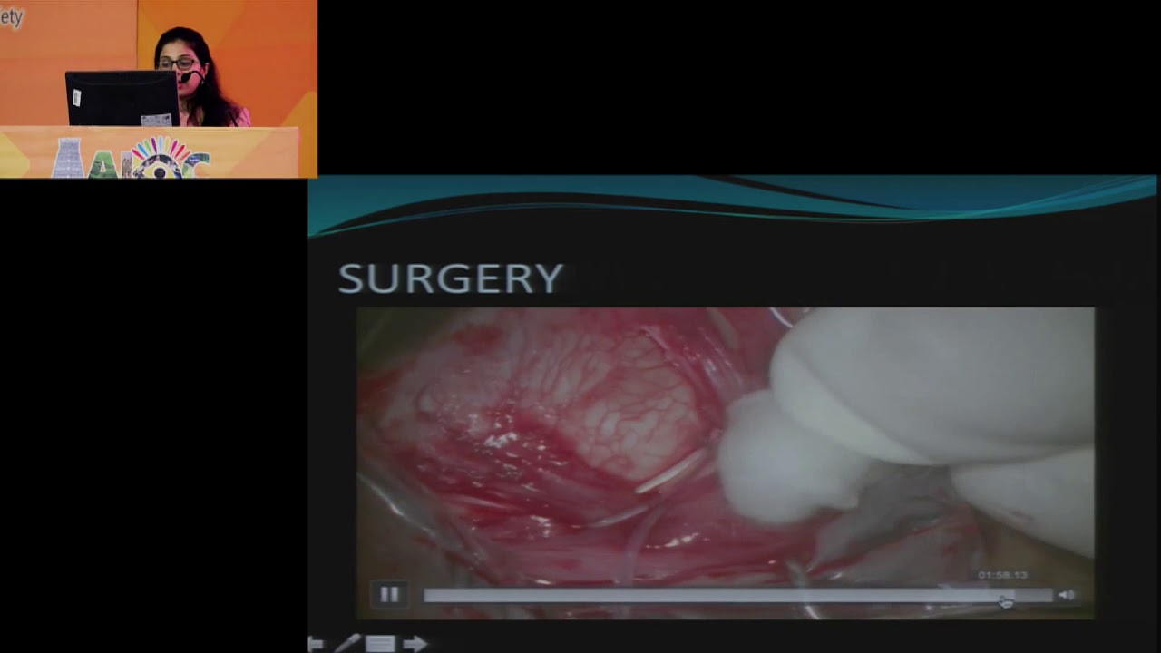 AIOC2018 - GP147 - [FP480] : SILICONE TUBE LOOP MYOPEXY : ... - YouTube