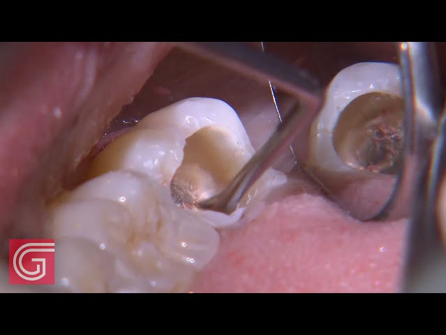 Occlusal Decay