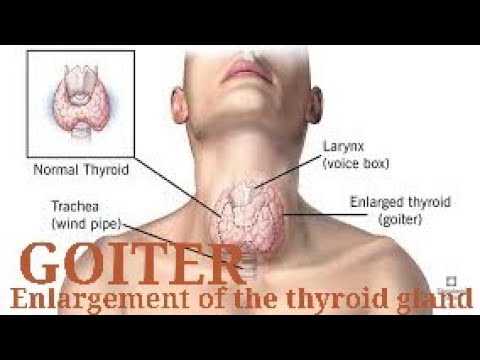 Thyroid Gland | Goiter | General Physiology and Pathology | Types | - YouTube