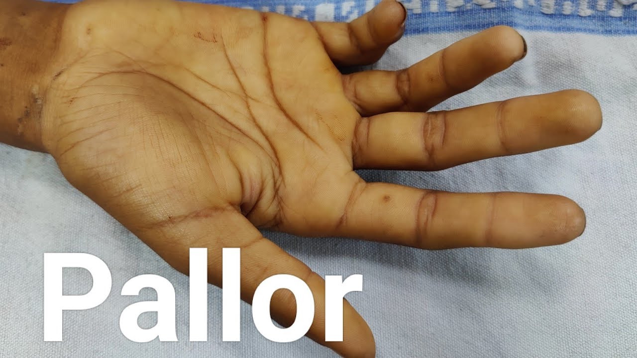 Pallor || Anemia - YouTube