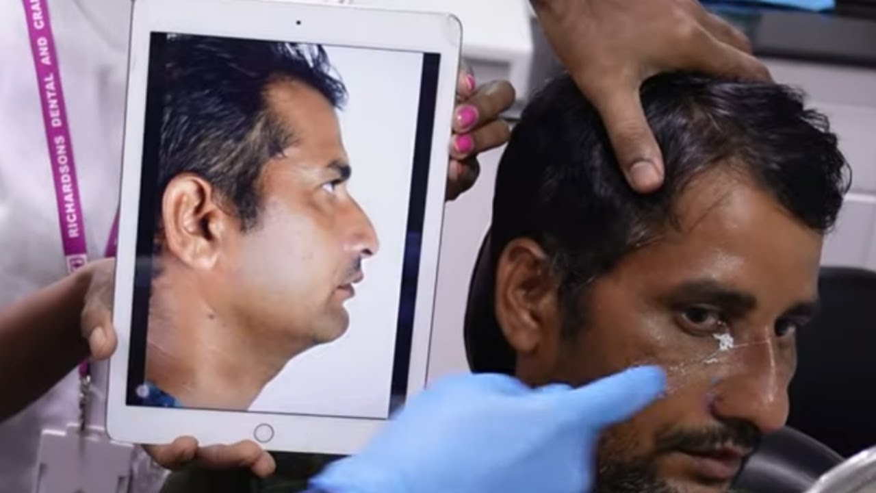 Nasal Splint Removal After Rhinoplasty Surgery | Before & After Results ...