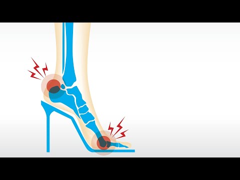 Easy Fixes For High Heel Pain, Arch Pain + Athlete's Foot | Dr. Brad From My Feet Are Killing Me