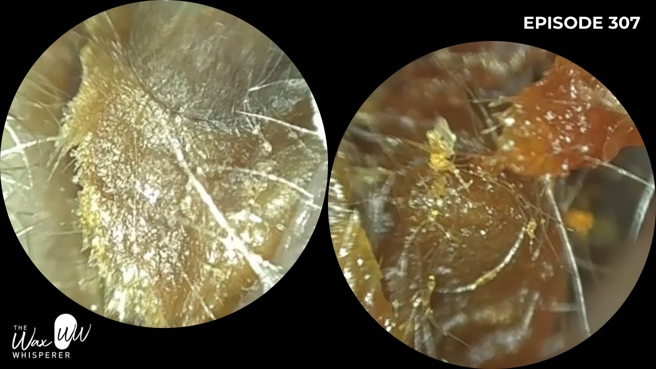 307 - Hopi Ear Candle Ear Wax Removal Gone Wrong Rescued by WAXscope®️ ...