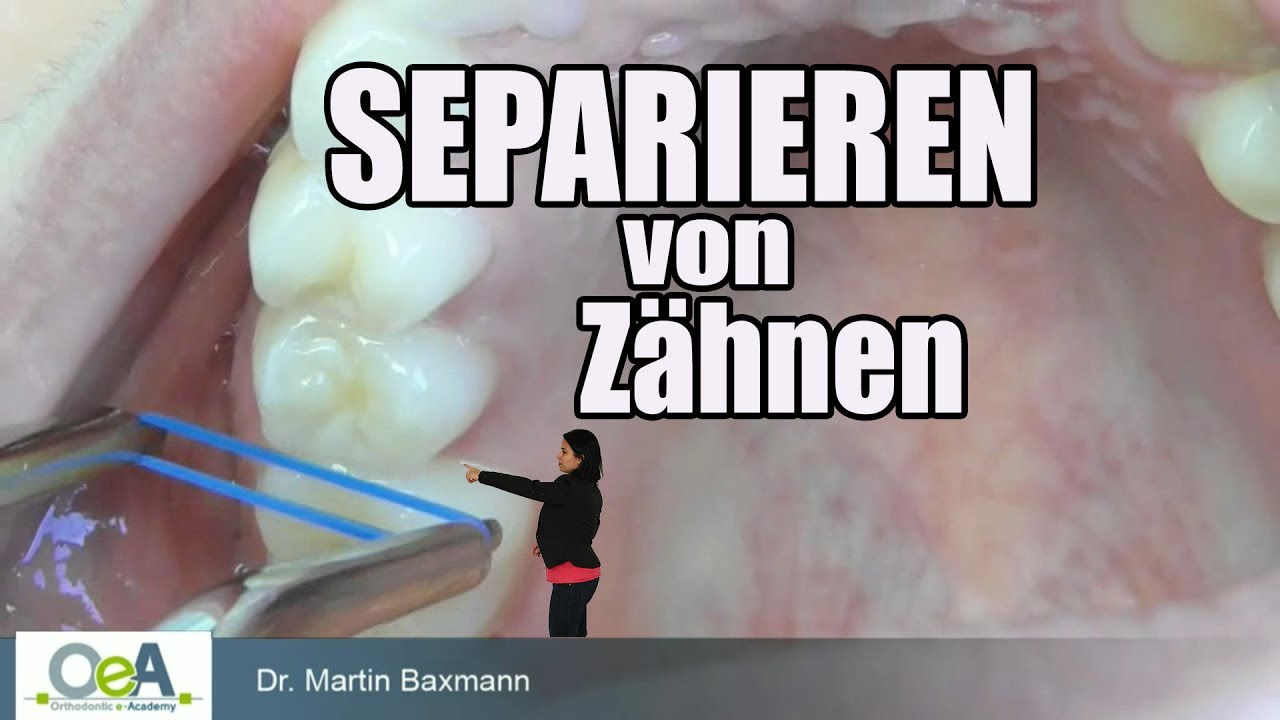 SEPARIEREN von Zähnen - SEPARATION of teeth I OeA - YouTube