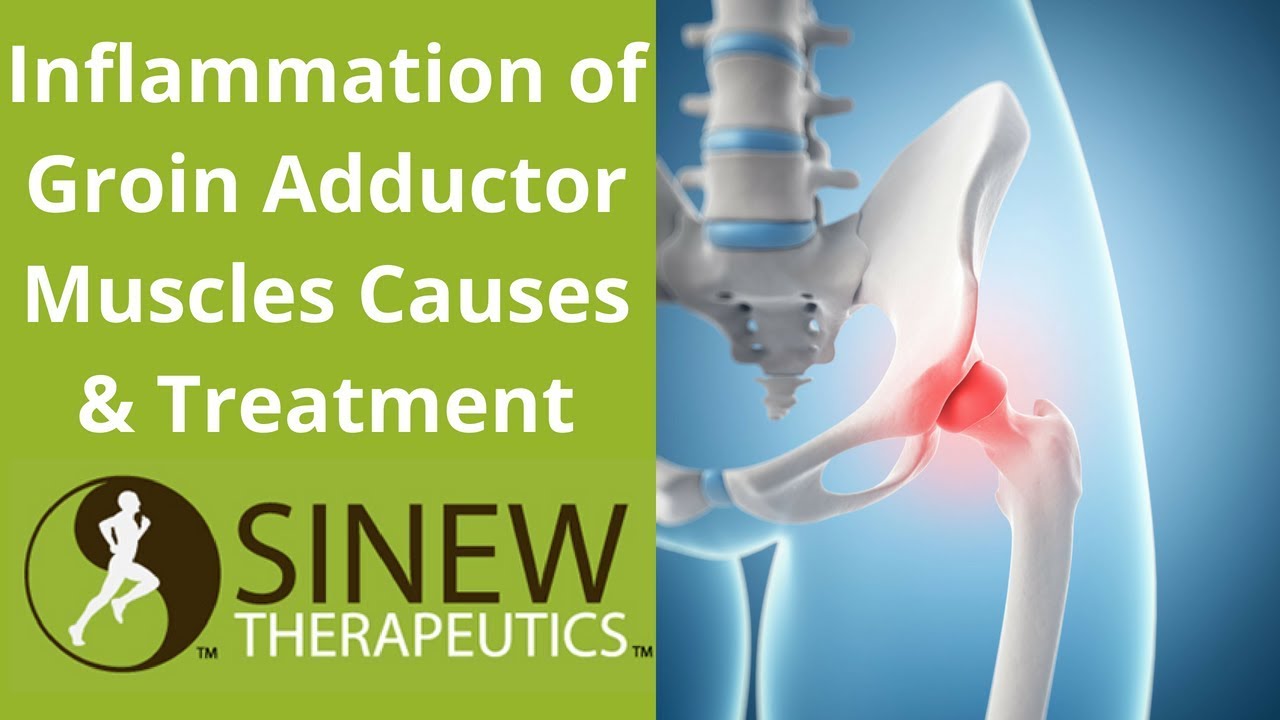 Inflammation of Groin Adductor Muscles Causes and Treatment - YouTube