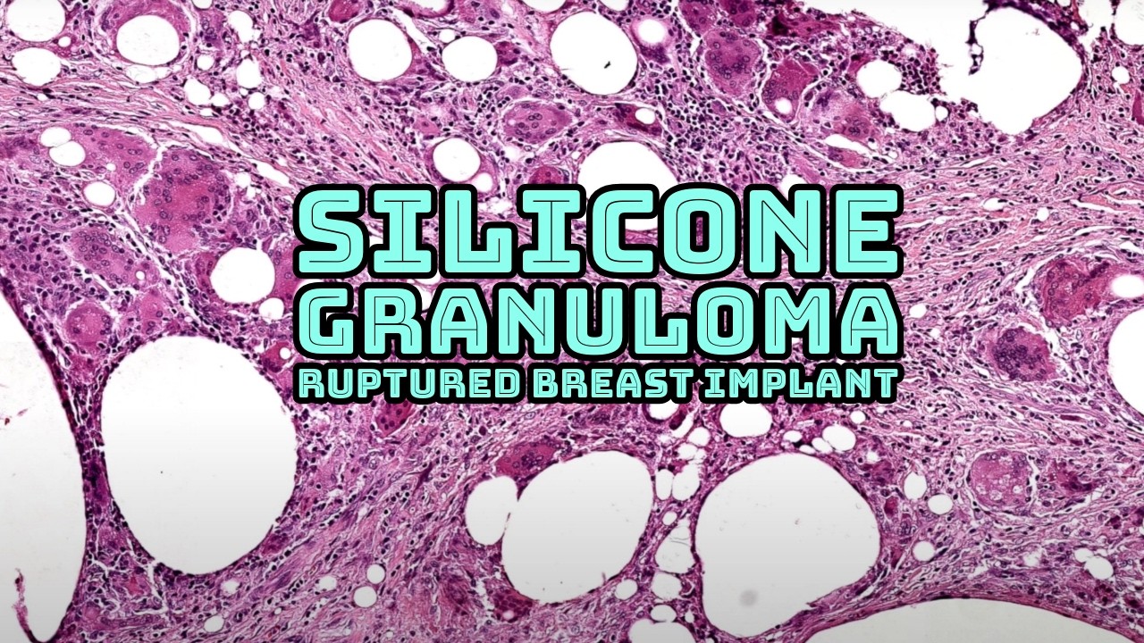 Silicone granuloma with foreign body giant cells (ruptured silicone ...