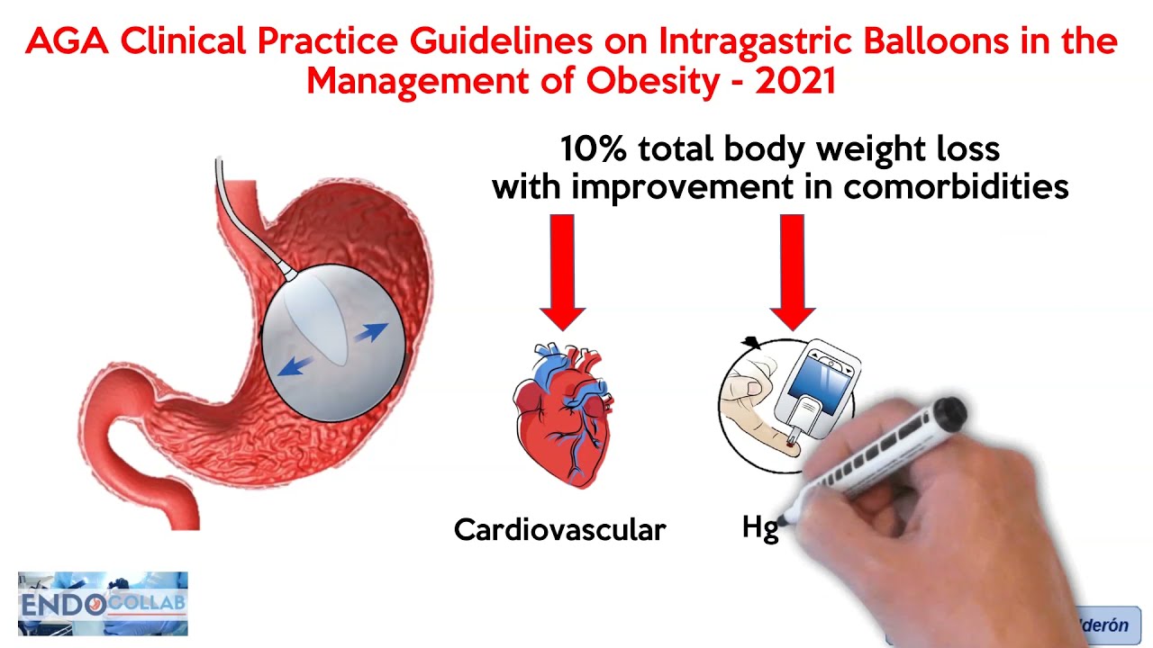 AGA Clinical Practice Guidelines on Intragastric Balloons in the ...