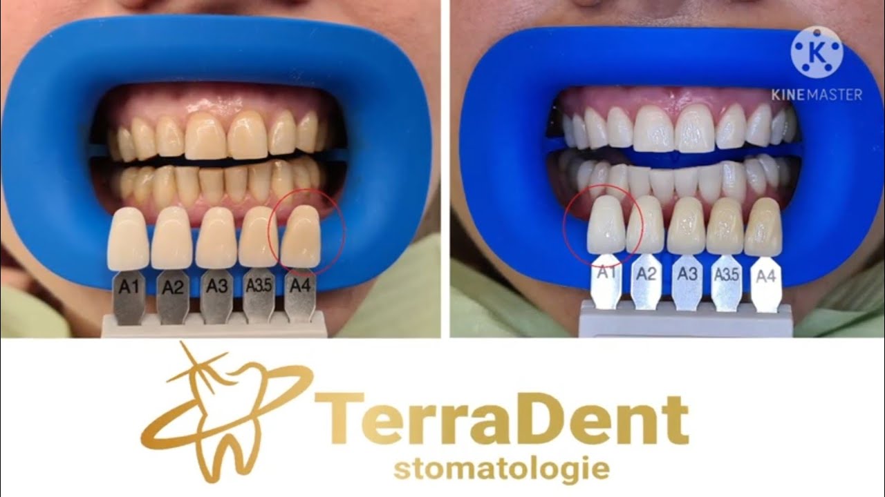 Stomatologie Chisinau, Botanica - TerraDent, Moldova! Albire dentara cu ...