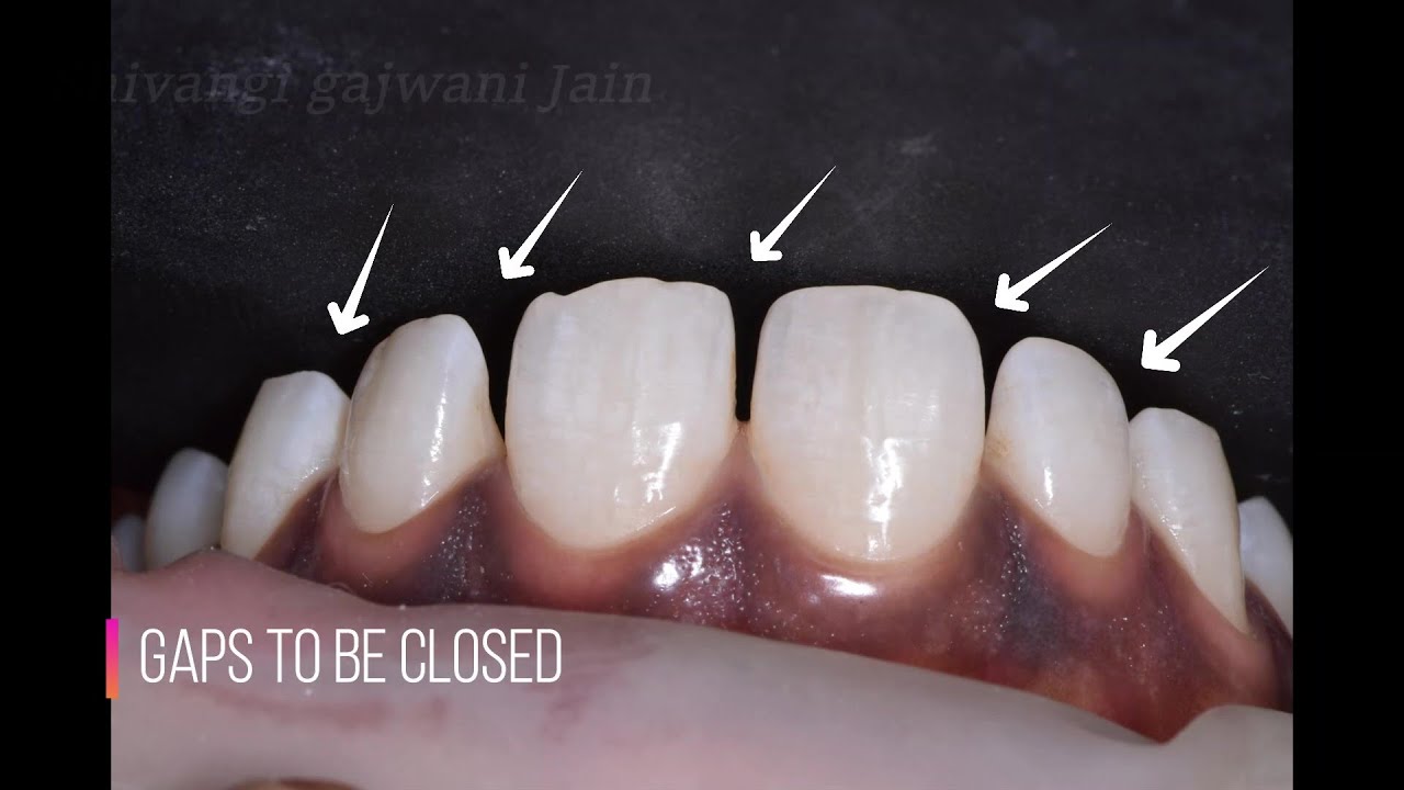 Direct Composite Mock Up: Free hand - YouTube