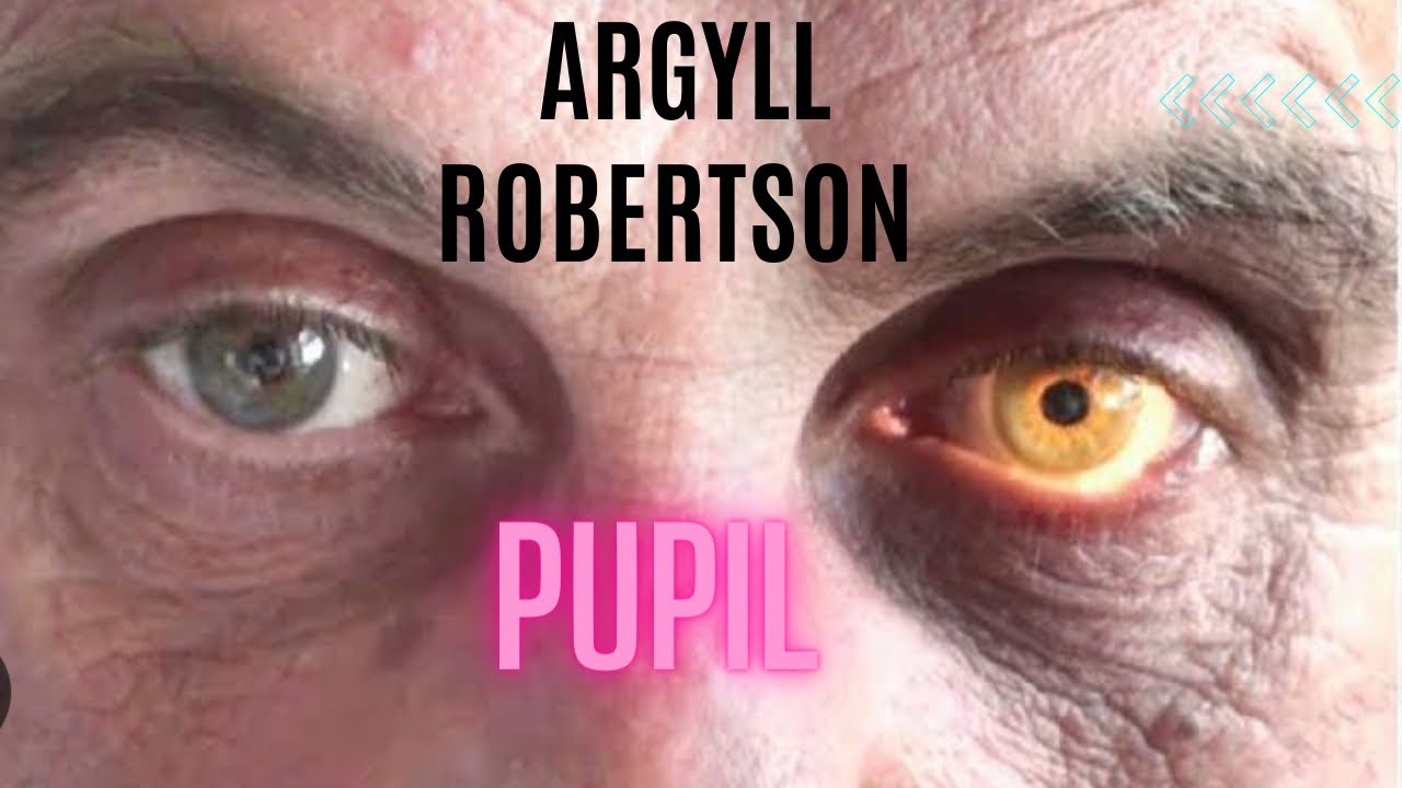 Argyll Robertson Pupil - YouTube