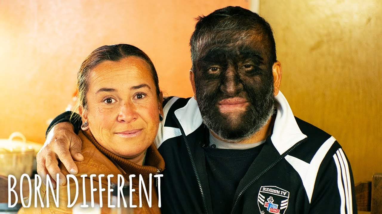 My girlfriend loves me - and my hairy face - born different