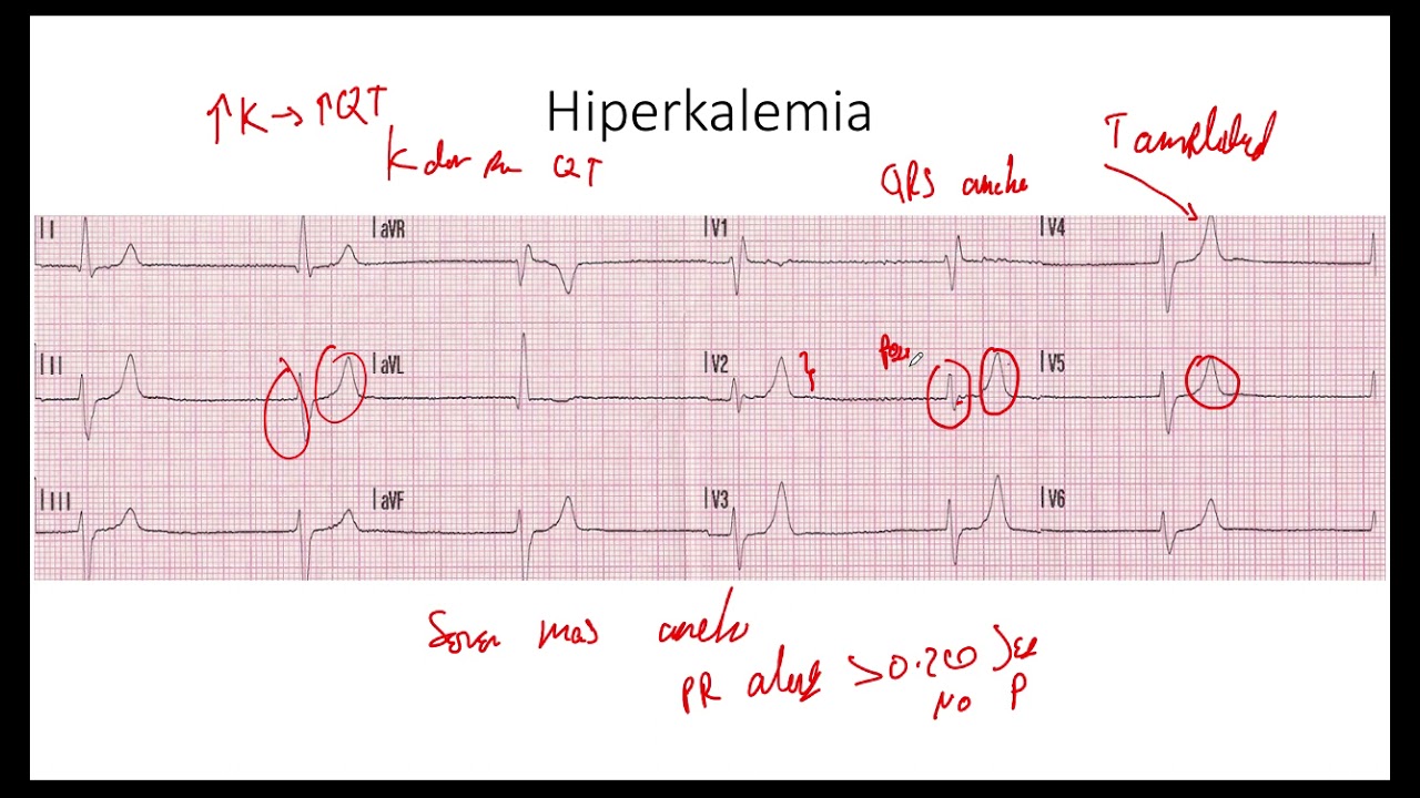 Tira De Ecg De Hipercalemia Fisiologia Cardíaca E ECG Cardiologia