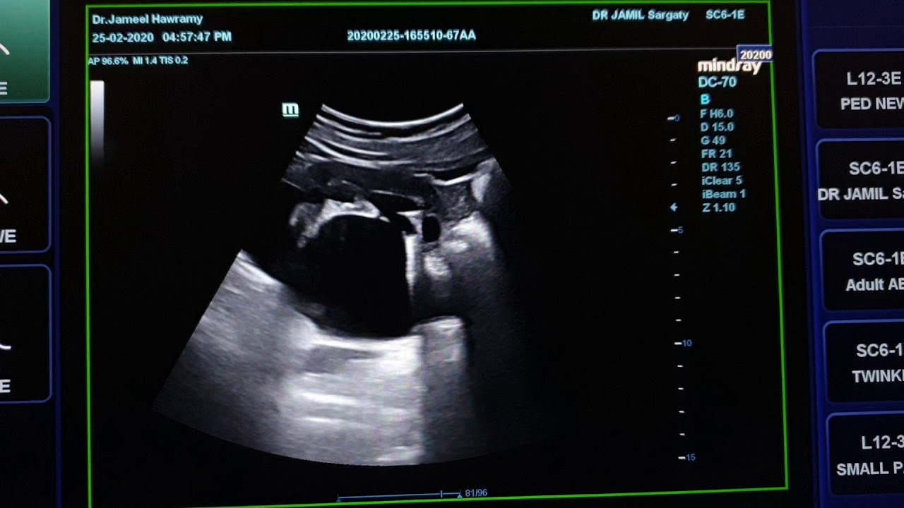 PUJ Stone Ultrasound - YouTube