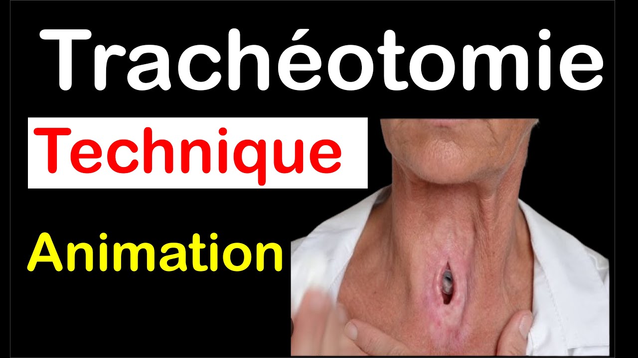 réanimation : trachéotomie matériels et technique - YouTube