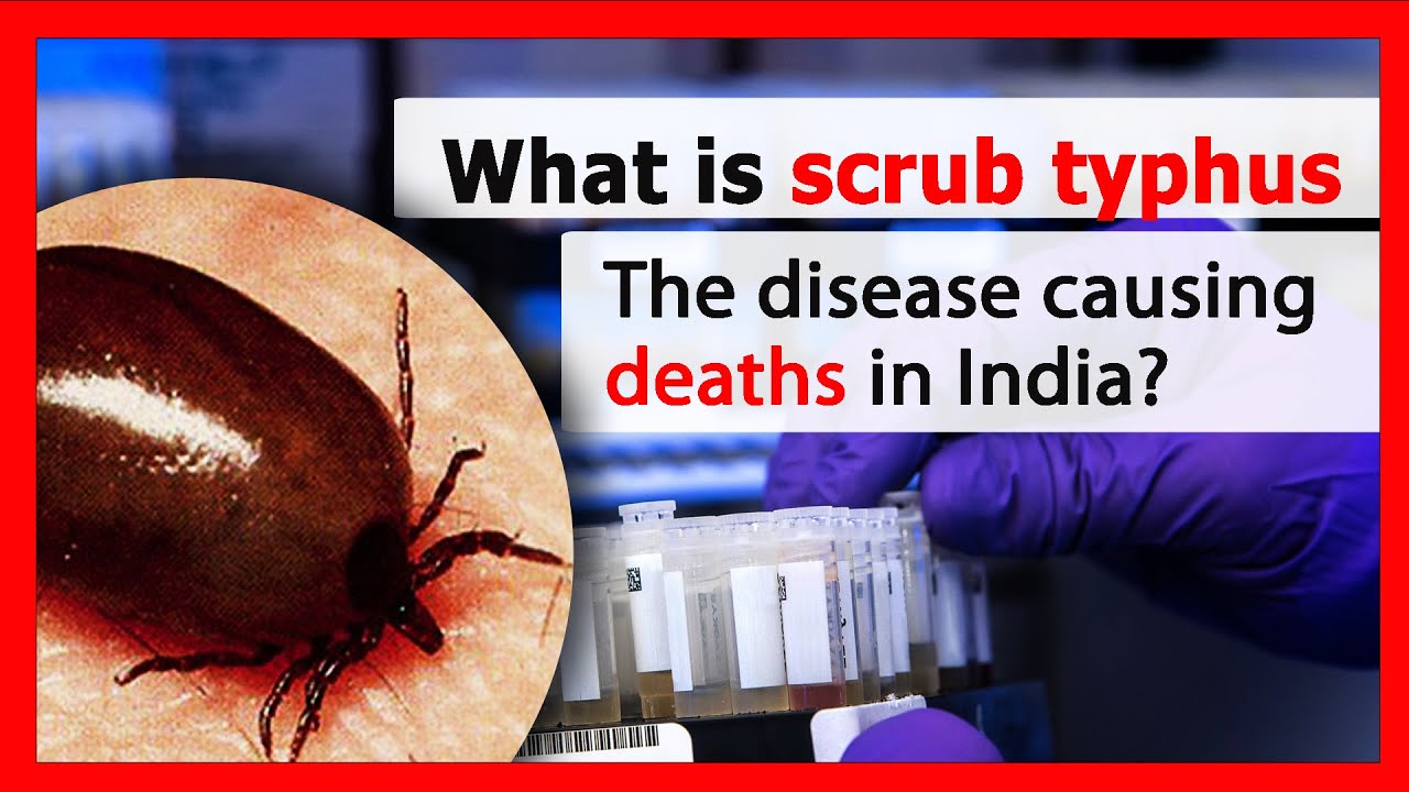 Scrub #Typhus: the disease that killed millions through ages - YouTube