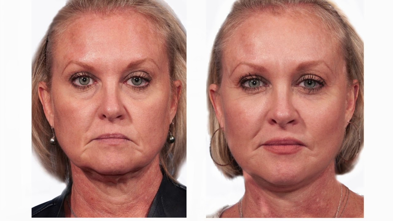Patient Testimonial: Facelift with Dr. Randy Sanovich - YouTube