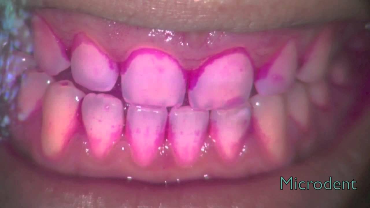 Uso del Rilevatore di Placca - YouTube