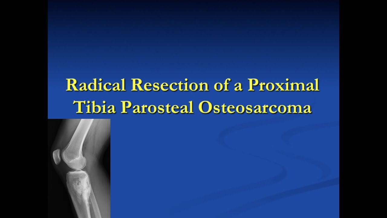Limb Sparing Resection for a Proximal Tibia Parosteal Osteosarcoma ...