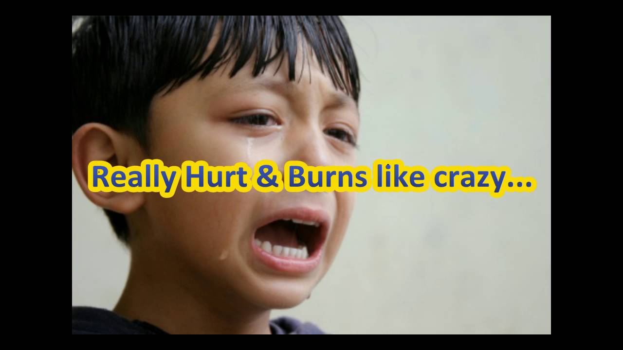 Sting Zapper Fire Ant Sting First Aid Waughs Nursery - YouTube