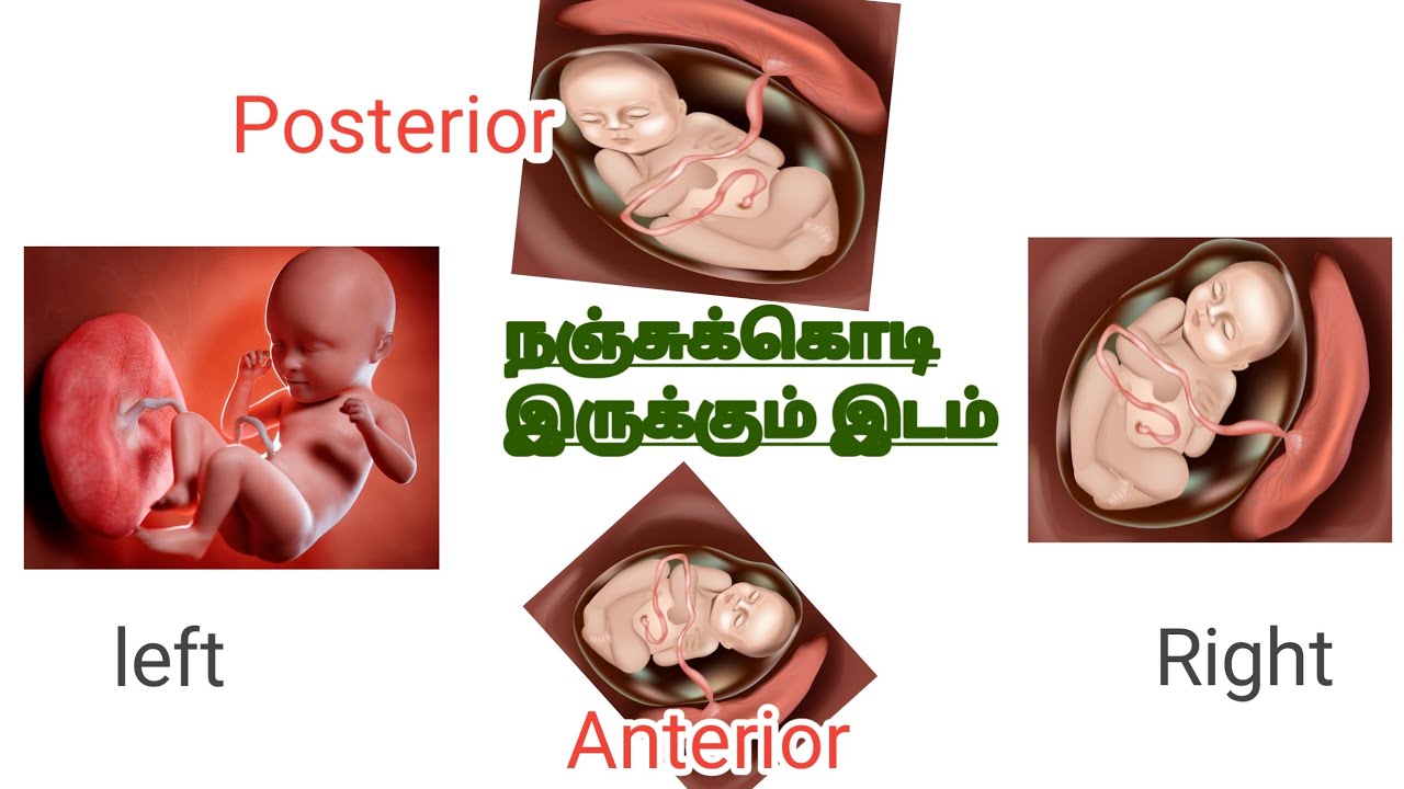 ஆணா ??பெண்ணா ?? ||Pink or Blue || Posterior and Anterior placenta ...