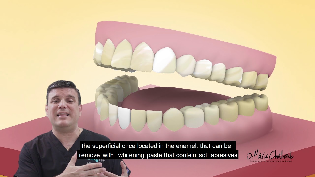 Blanqueamiento Dental con el Dr. Mario Chalhoub - YouTube