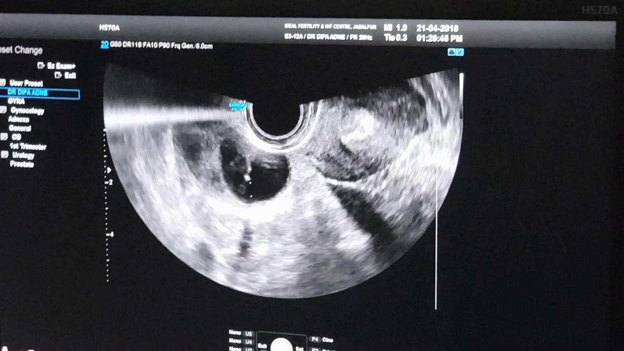 TESA-ICSI-IVF :निल शुक्राणु से ग्रसित दम्पत्ति के IVF एवं TESA का सजीव ...