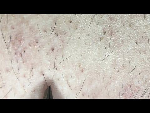 Ingrown back hairs part 12 - YouTube