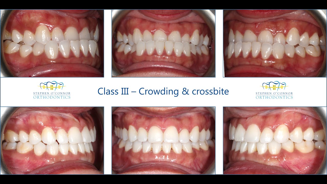 Class III occlusion - Removal of two lower premolar teeth & Clear ...
