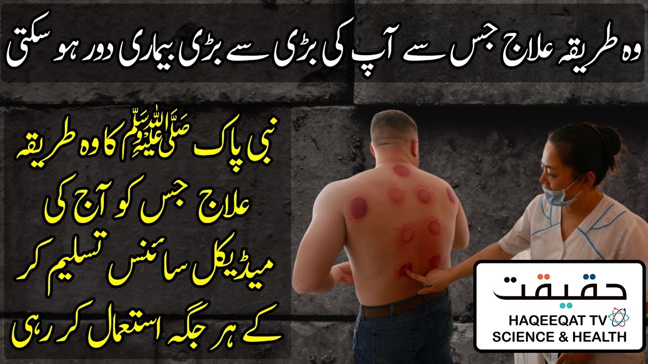 How Cupping Therapy or Hijama is Getting Popularity in Medical Science ...