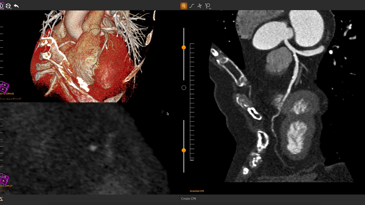 Myocardial bridge - YouTube
