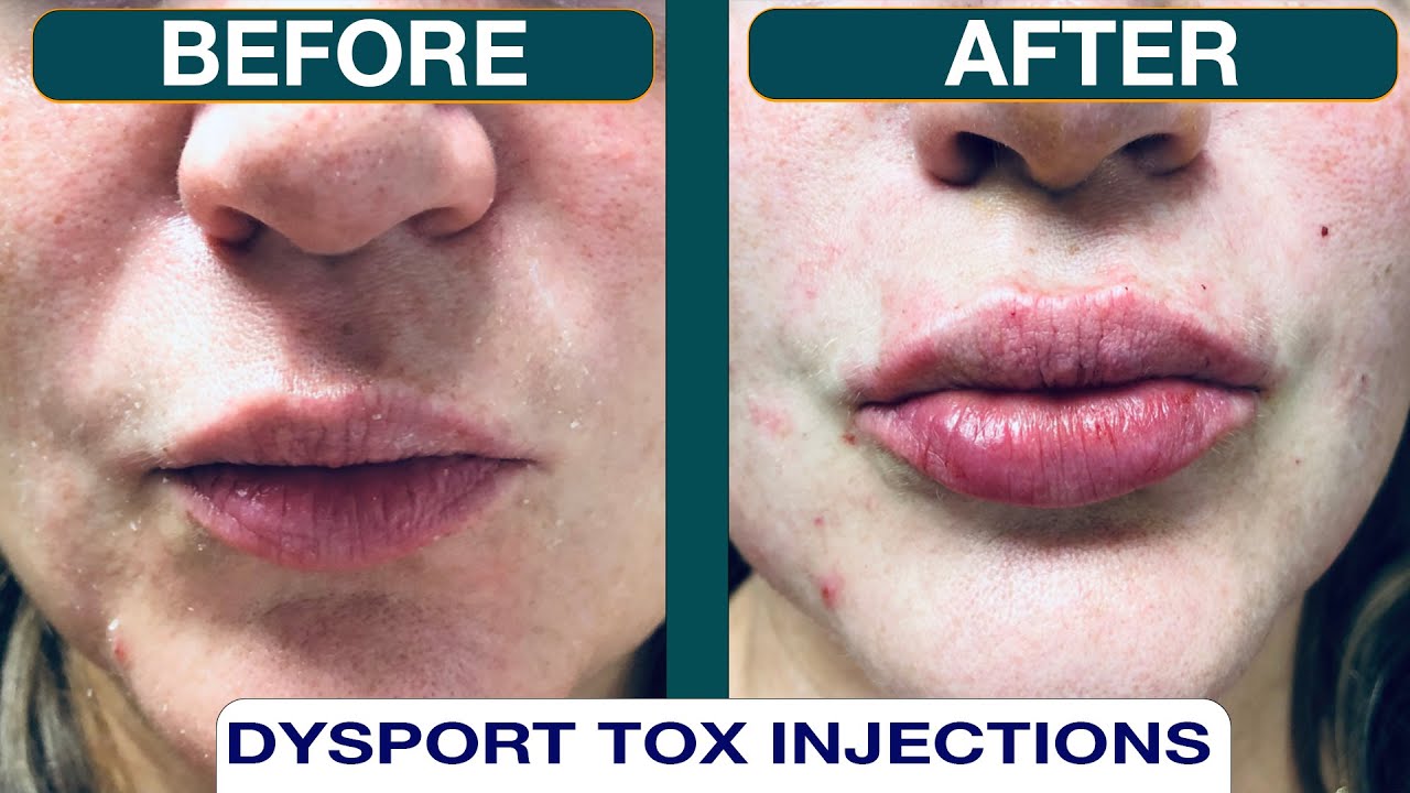 Dysport Tox injections and Laugh Line Dermal Filler | Khalifeh Plastic ...