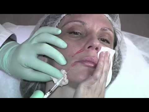 Live demonstration by dr. Luca Piovano using ELLANSÉ - YouTube