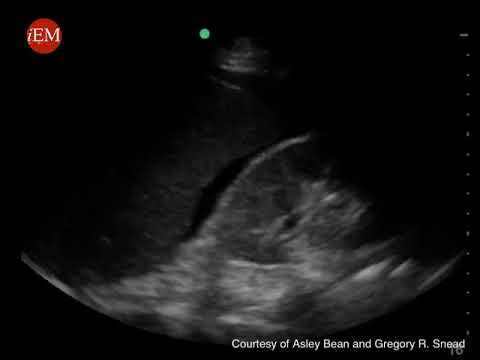 SS Video 12 Abnormal Right Upper Quadrant - YouTube