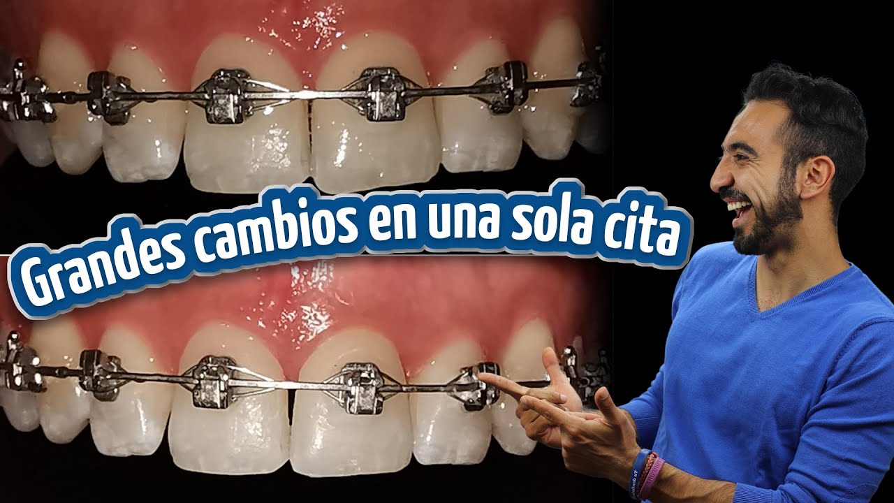 Dientes más Bonitos en una Cita - YouTube