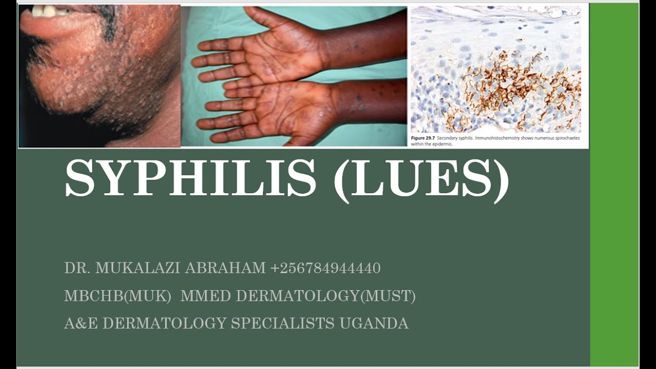 SYPHILIS BY DR ABRAHAM - YouTube