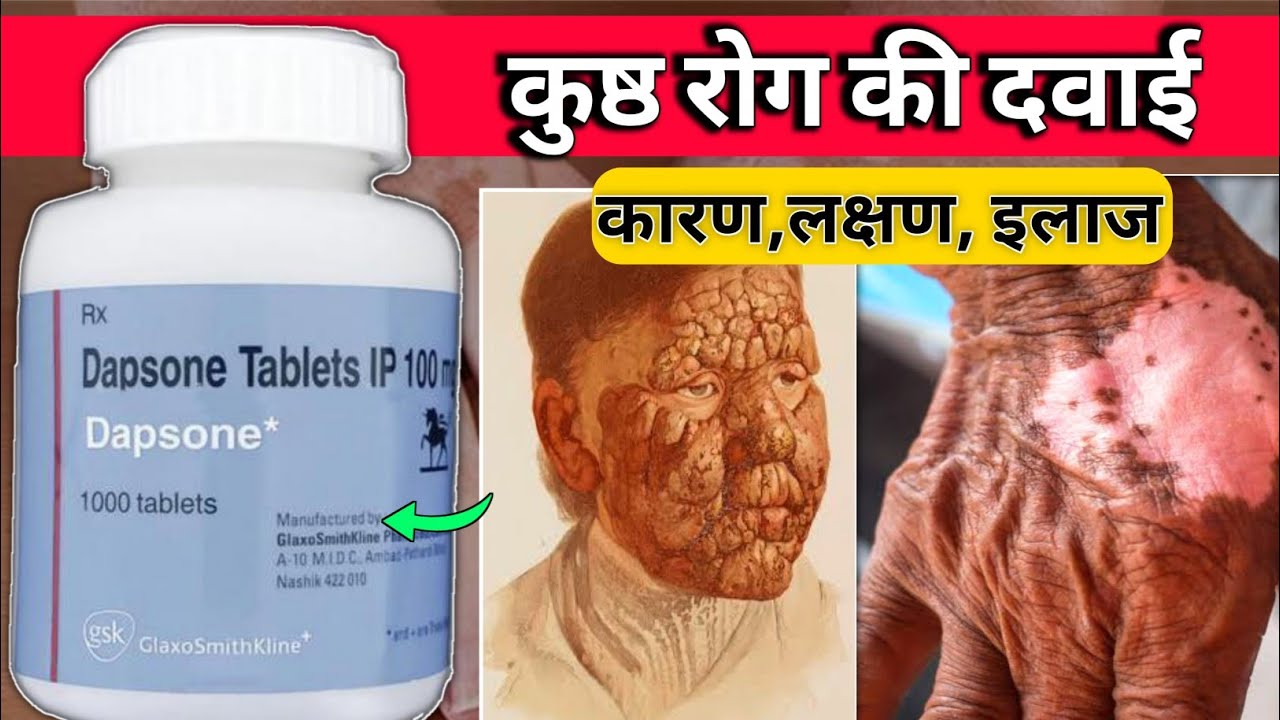 Dapsone Tablet || कोड या कुष्ठ रोग का इलाज || Dapsone Uses,Side effects ...