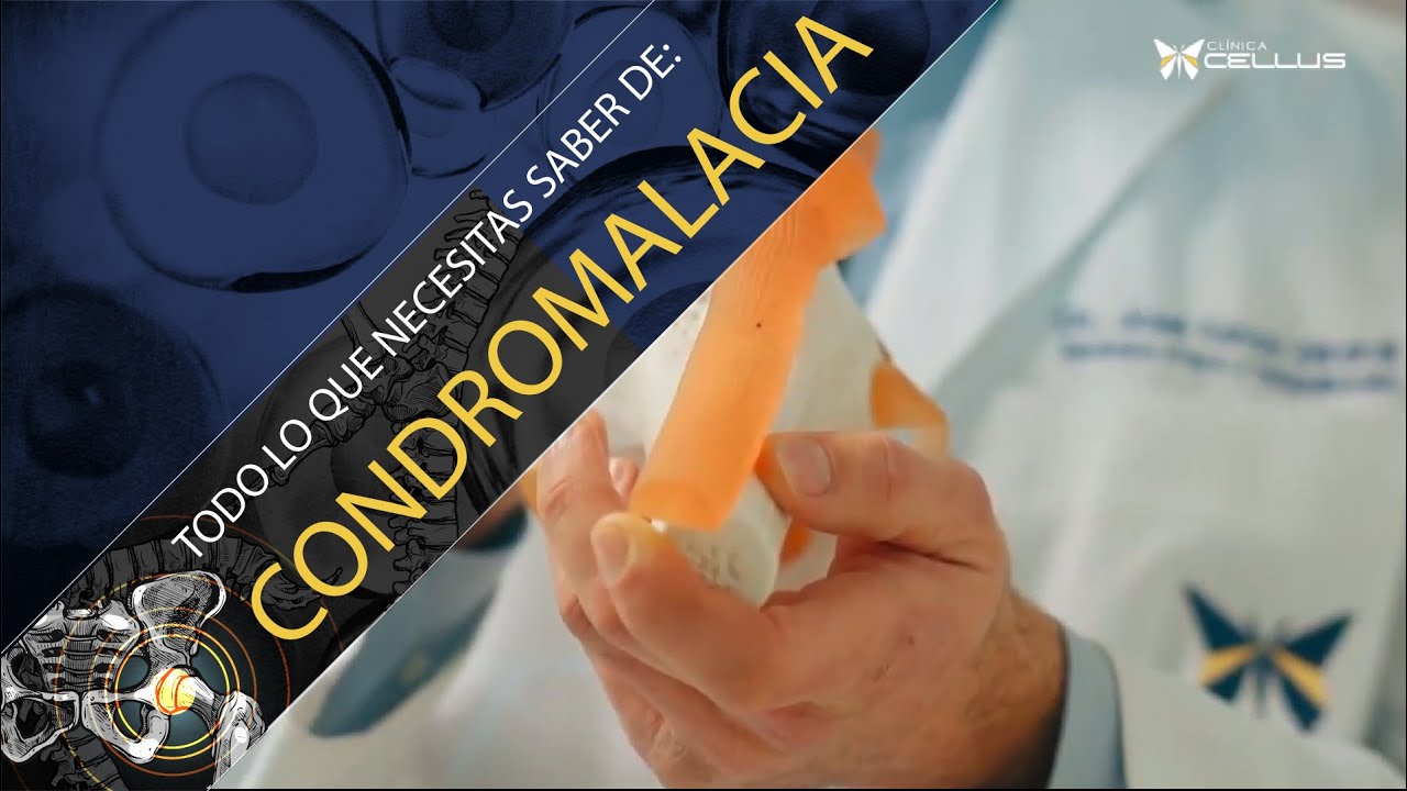 Condromalacia o Condropatía Rotuliana. Despeja todas tus dudas sobre ...