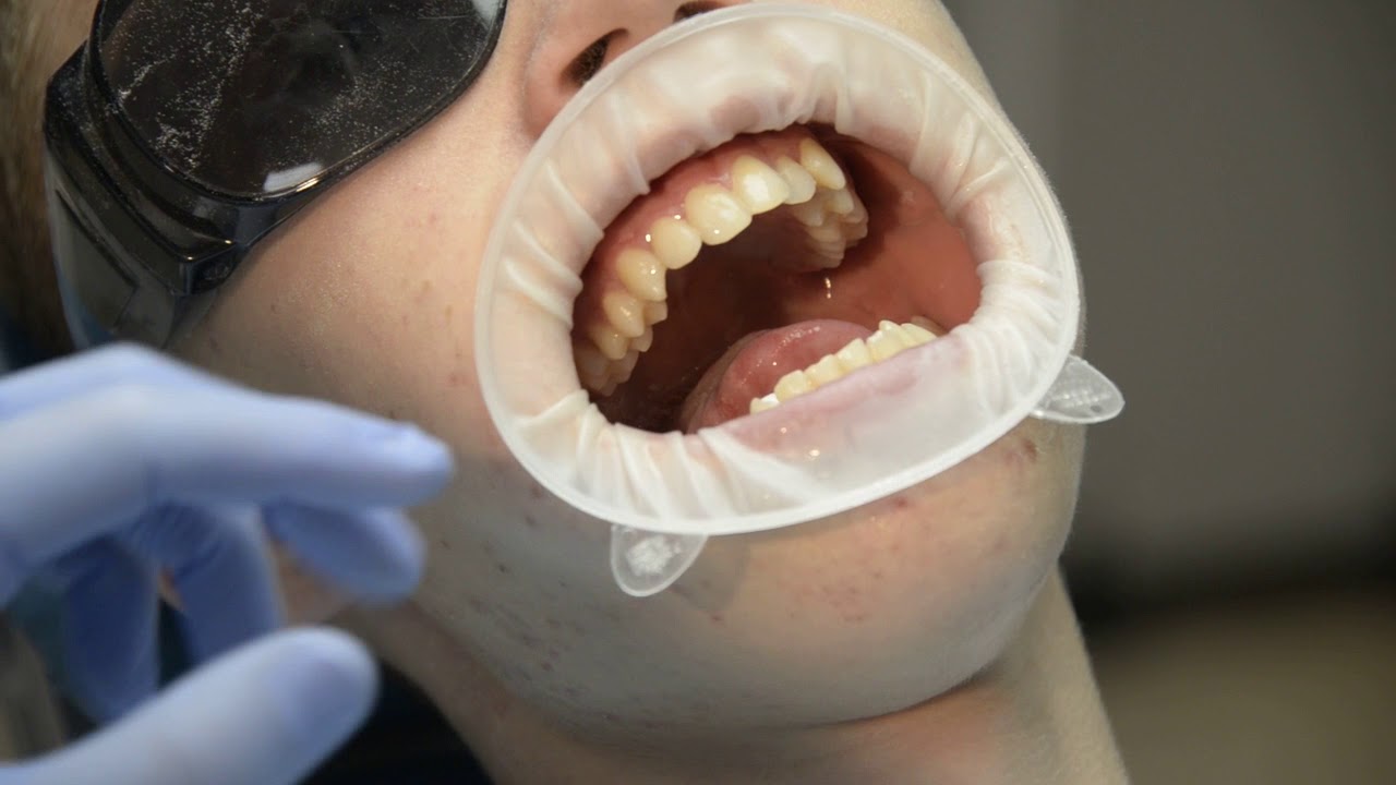 How to Create Teeth Buttons - YouTube