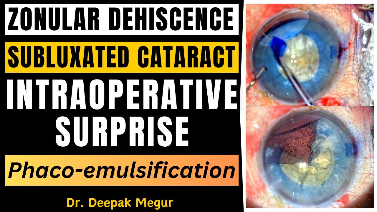 Zonular dehiscence & subluxated cataract & Intraoperative surprise - Dr ...